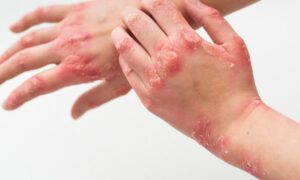 L'eczéma : causes, symptômes et traitements
